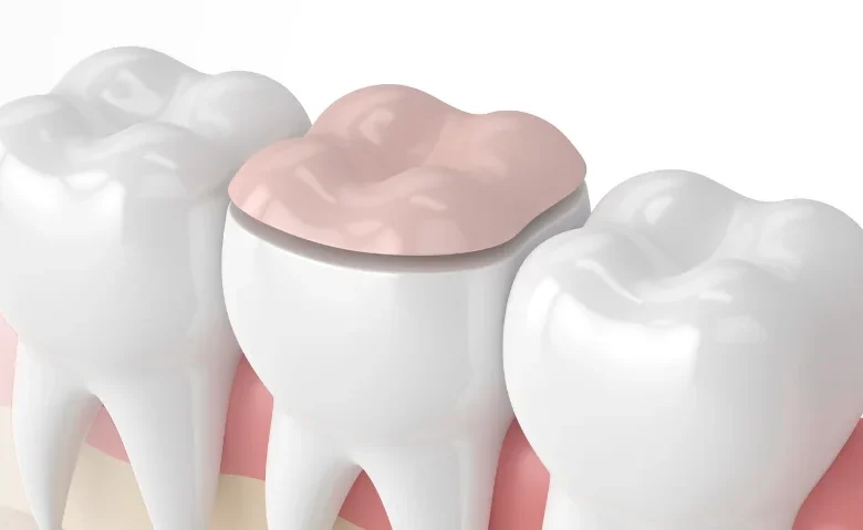 Teeth Inlays & Onlays Sugar Hill, Johns Creek, Buford, & Suwanee